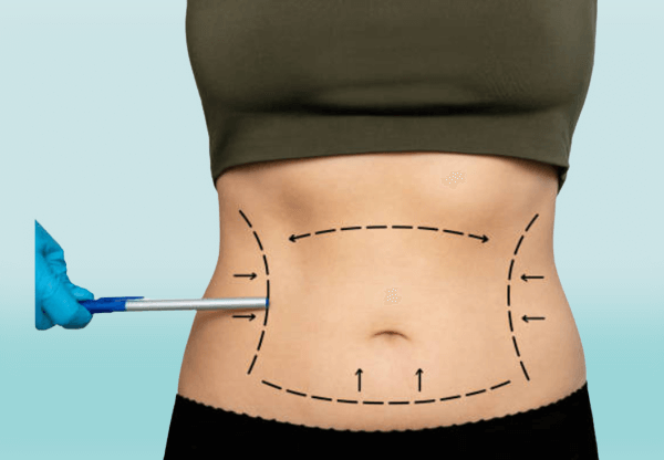 Can Liposuction Give You A Flat Stomach: What You Need to Know - My ...